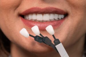 How Long Do Veneers Last?